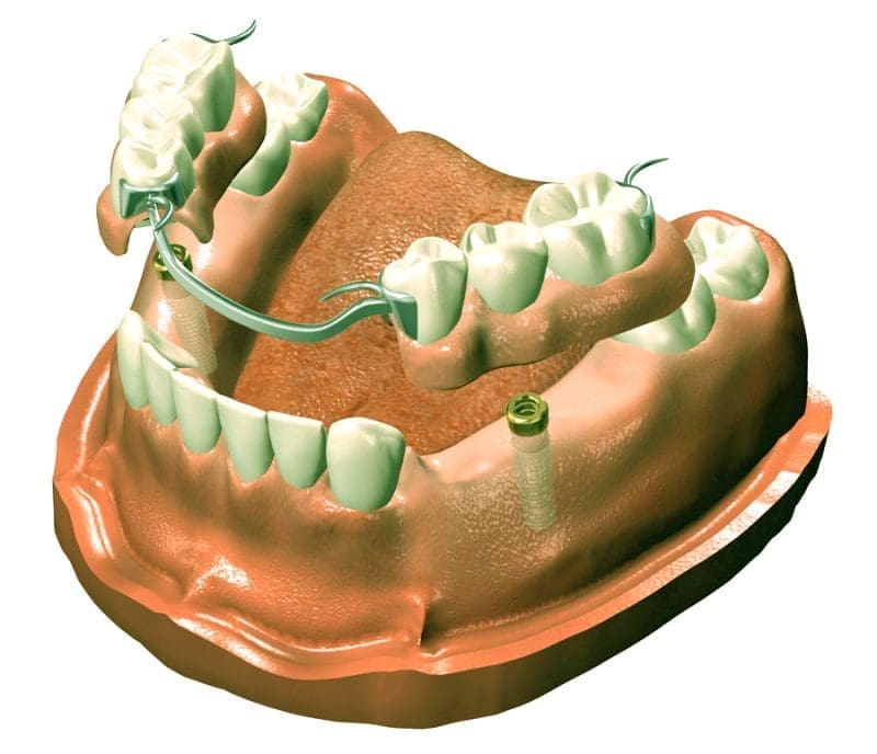 Tout savoir sur les prothèses partielles dentaires - Benoit Viau ...